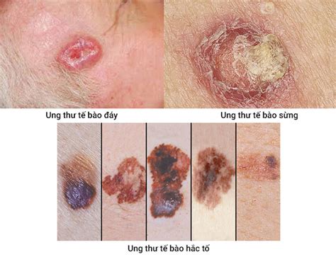Tin Tức Cao Niên Thế Kỷ XXI bệnh ung thư dễ mắc khi về già