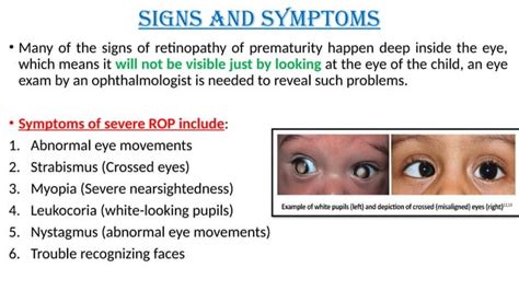 Retinopathy Of Prematurity Rop Pptx Retinopathy Of Prematurity Rop Pptx
