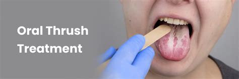 Oral Thrush Symptoms And Effective Treatment Solutions