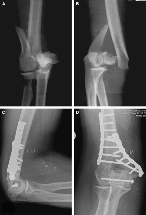 Functional Outcome Of Complex Intercondylar Fractures Of The Distal