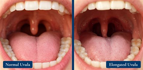 Normal Uvula Position