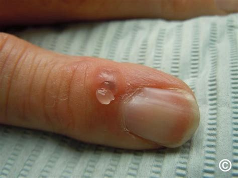 Myxoid Cyst Syn Mucous Cyst