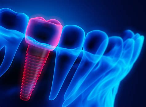 How Can Dental Implants Restore Your Natural Smile Washington Dc