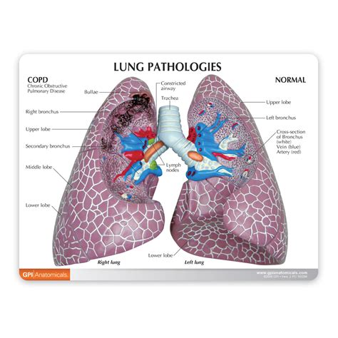 Lung Model Set With Pathologies Gpi 3d Anatomy