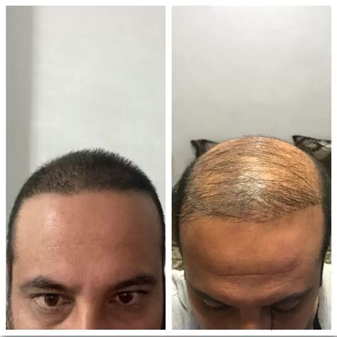 4 Month Update Daily Min And Topical Fin Micro Needling Progress