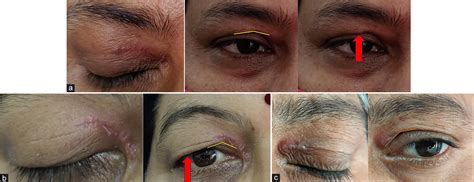 Surgical Management Of Xanthelasma Palpebrarum Reducing Angular Defect
