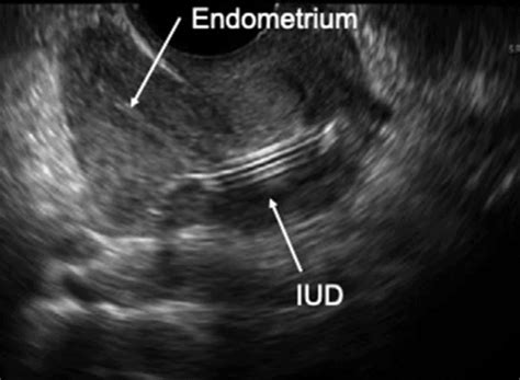 Ultrasound Iud Location