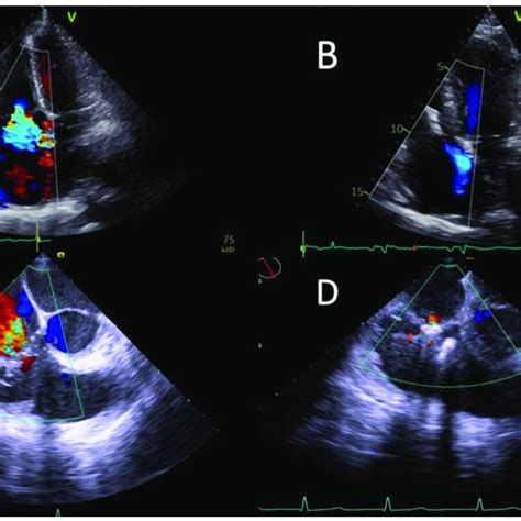 Echocardiographic Pictures Of Successful Tr Reduction After Teer