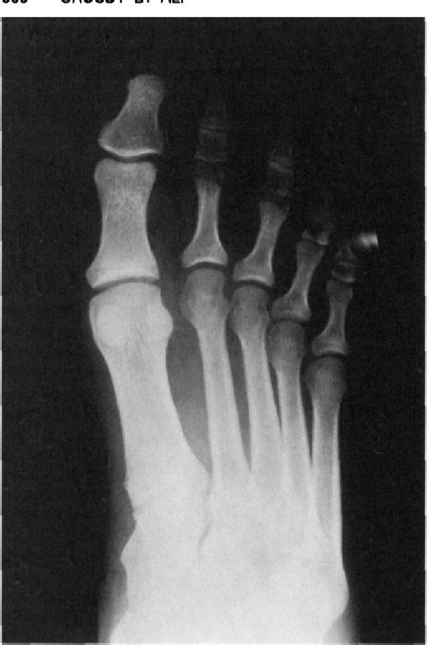 Distal Interphalangeal Joint Dislocation Toe At Carmen Elliott Blog