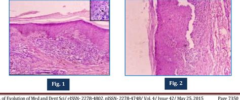 Interface Dermatitis Semantic Scholar