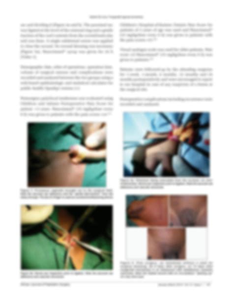 Solution Herniotomy In Resource Scarce Environment Comparison Of