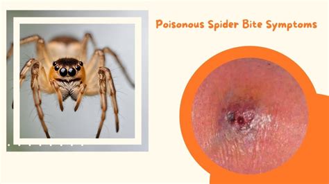 17 Types Of Spider Bite Symptoms Id With Pictures