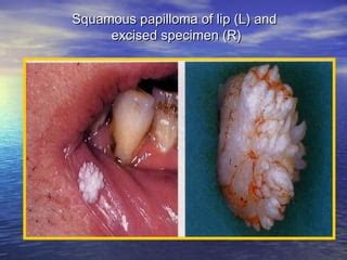 Tumor Of Oral Cavity Ppt