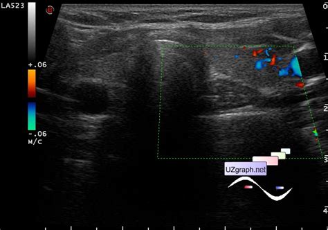 Richly Vascularized Thyroid Nodule Thyroid Gland Sonography Clinical