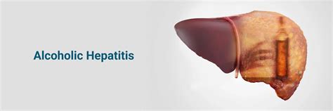 Alcoholic Hepatitis Liver
