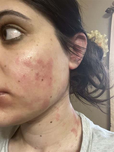 Anyone Have Any Advice For Face Psoriasis Products Washes Etc R Psoriasis