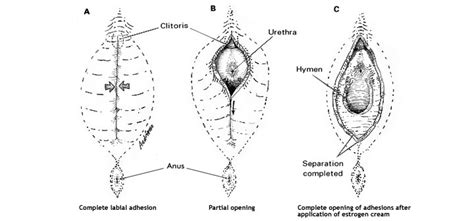 Labial Adhesions Center For Young Womens Health