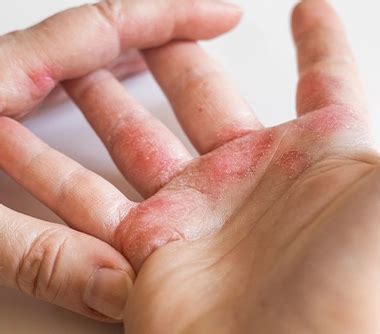 Visual Guide And Photos Of Eczema Vs Psoriasis Dermal Therapy