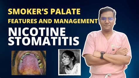 Dr Rudra Mohan Nicotine Stomatitis Papules Spots On Palate Due To