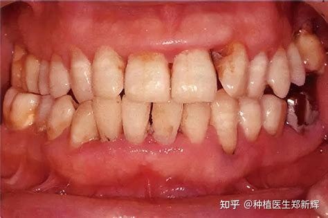 患有牙周炎，专家告诉你真正有效的解决办法 知乎