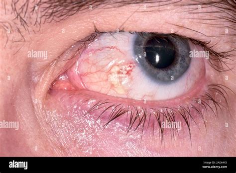 Molls Cyst In The Eyelid Close Up Of A Molls Cyst On The Lower Eyelid Of A 44 Year Old Female