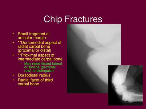 What Is A Chip Fracture At Jane Shepherd Blog