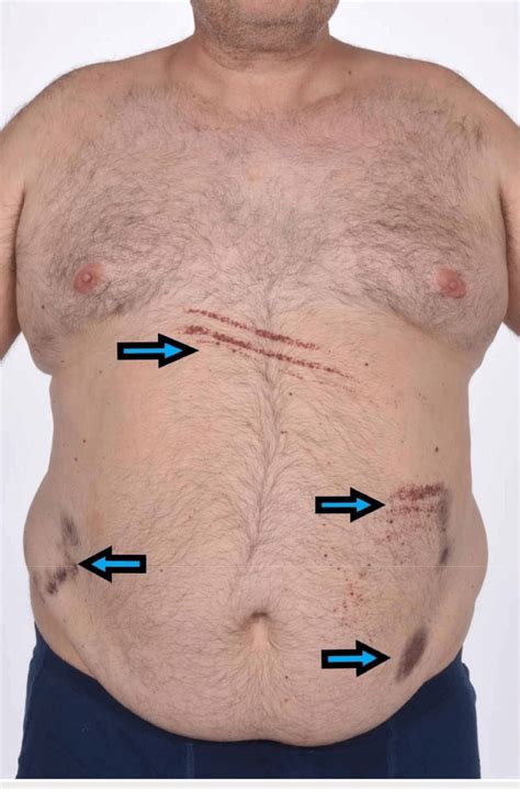 Multiple Contact Induced Petechiae And Ecchymoses On Patients Abdomen