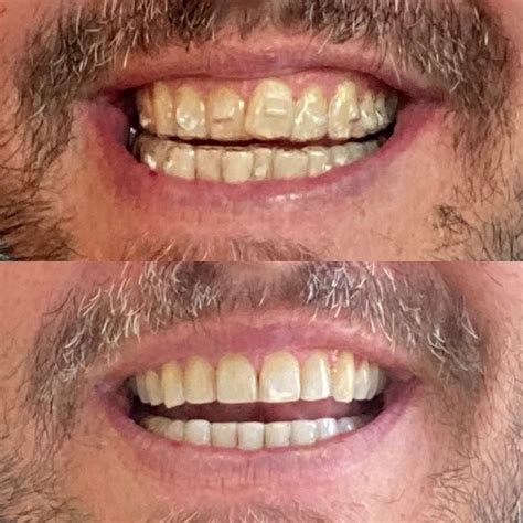 Progress So Far 1018 With Pontic For Missing Lateral Incisor R