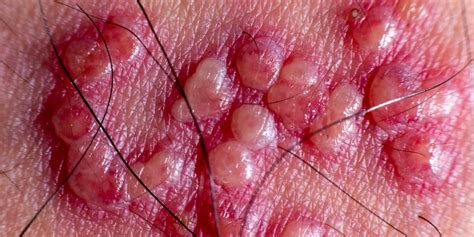 Identifying The Std Behind Bumps On The Buttocks A Spotlight On