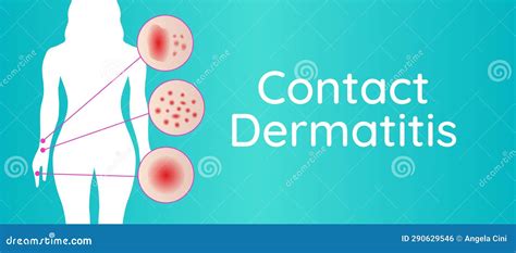 Contact Dermatitis Atopic Eczema Cartoon Vector