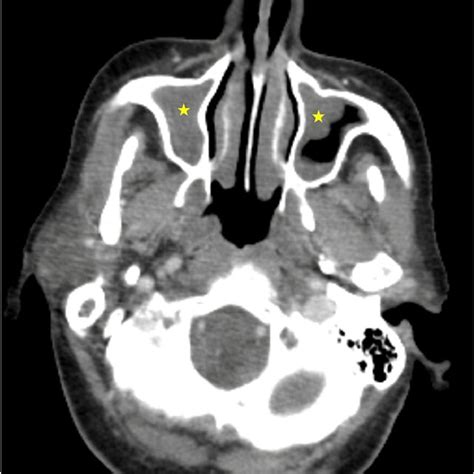 Maxillary Computed Tomography Ct Scan Showing Acute Inflammatory