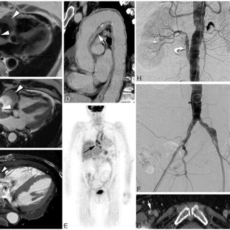 Diffuse Cardiovascular Involvement Was Observed Cardiac Mr A B And Download Scientific