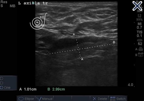 Ultrasound Appearance Of Axillary Lymph Nodes Rodrigo Arrangoiz Ms Md Facs Fsso
