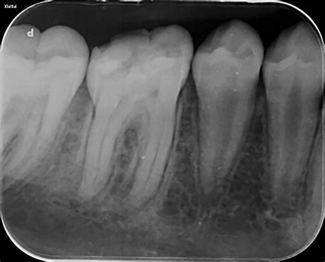 Cases Caendodonticsltd Dentures Save Your Tooth Root Canal