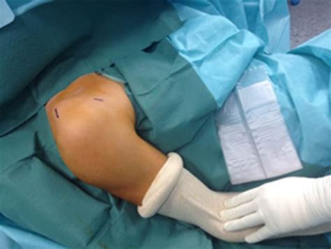 Performing A Longitudinal Incision On The Skin Projection Of The