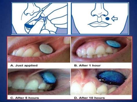 Buccal Drug Delivery System