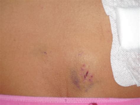 Interstim Anyone Satuday Wednesdays Update And Stage 2