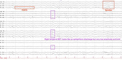Normal Variants — Learning Eeg