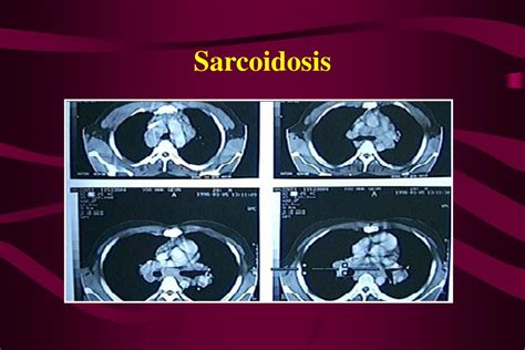 Ppt Sarcoidosis Powerpoint Presentation Free Download Id787934