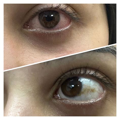 Conjunctival Naevus Removal London Hertfordshire And Essex