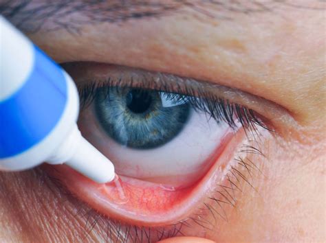 Artificial Tears Gel Eye Care Guide For Patients