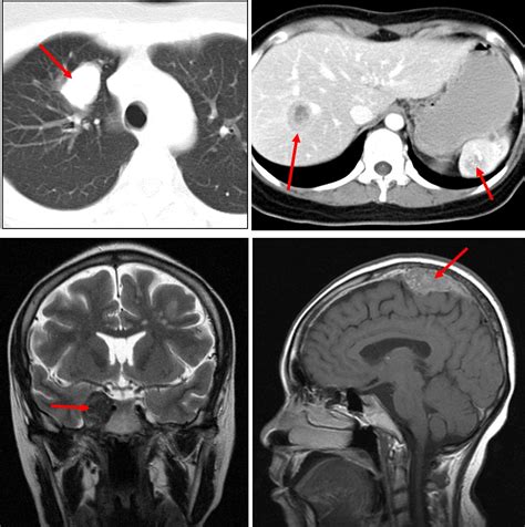 Inflammatory Pseudotumour Lung Liver Spleen And Brain Involvement Radiology Cases