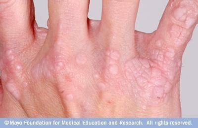 What Do Common Hand Warts Look Like