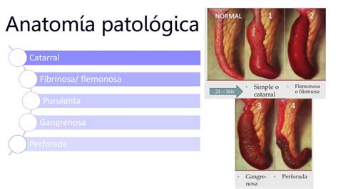 Apendicitis Definicion Epidemiologia Fases Y Escalas Diagnosticas Pptx