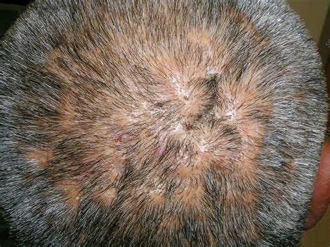 Scalp Cellulitis Scalp Cellulitis