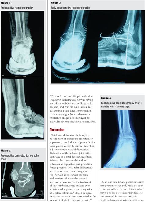 Figure 1 From Closed Total Talar Extrusion After Ankle Sprain