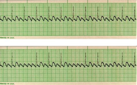 Ekg Detective Atrial Flutter