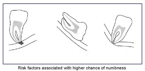 Are Retained Root Tips A Problem 1311 Jackson Ave Dental Dentist