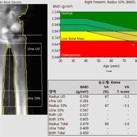 Dual Energy X Ray Absorptiometry Image Of The Left Forearm Two Regions Download Scientific