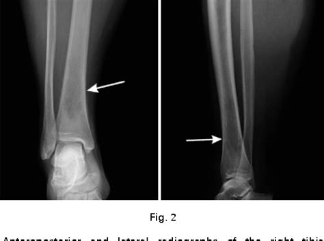 Figure 1 From Simultaneous Osteonecrosis And Osteomyelitis In A Patient